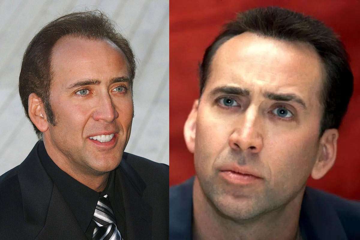 Unbelievable? 10 Celebrities Who Have Had Hair Transplants