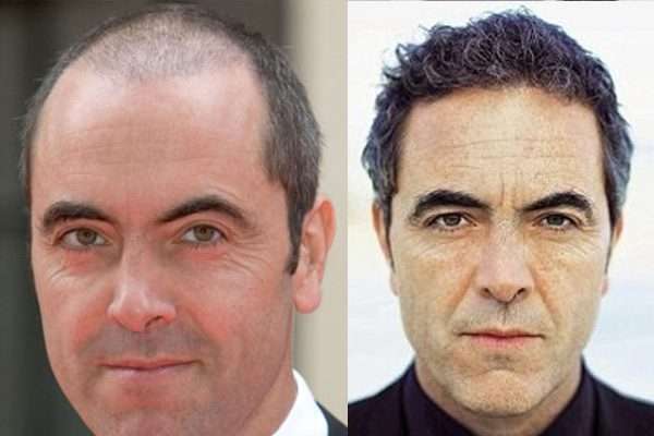 Unbelievable? 10 Celebrities Who Have Had Hair Transplants